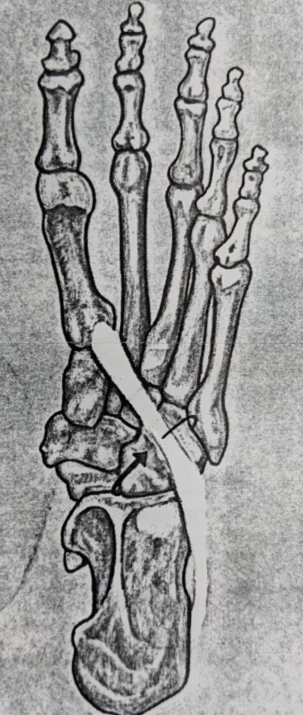 Cuboid Syndrome - Paragon Orthotic Laboratory