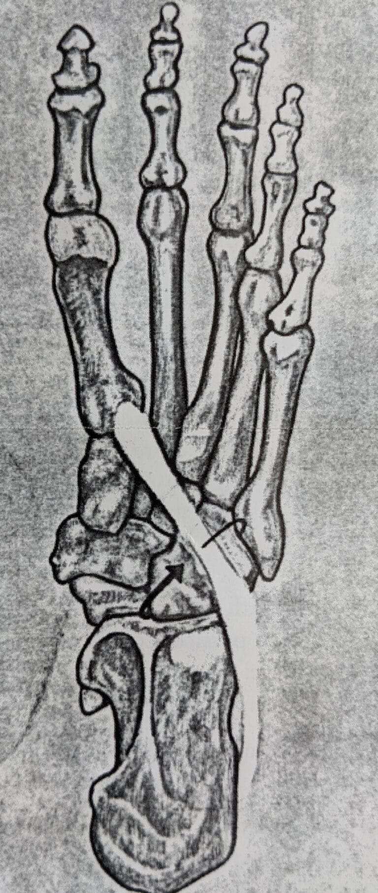 Cuboid Syndrome - Paragon Orthotic Laboratory