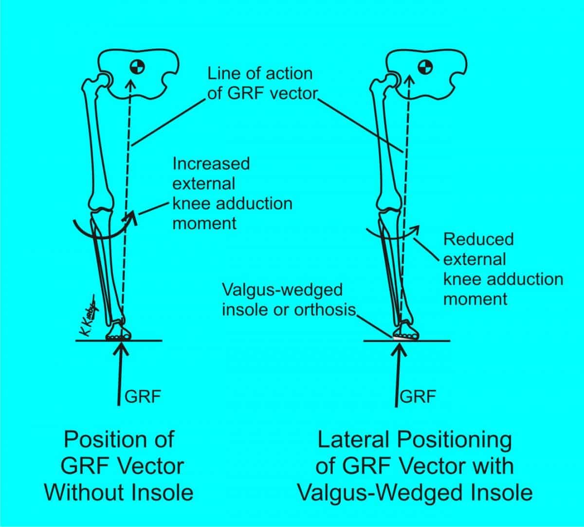 Can Foot Orthoses Have An Impact For Knee Osteoarthritis? - Paragon ...