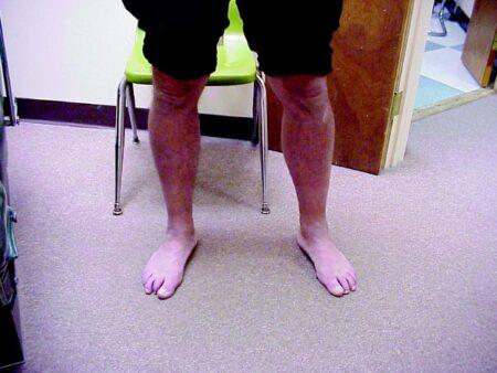 Keys To Assessing And Managing Limb Length Discrepancy - Paragon ...